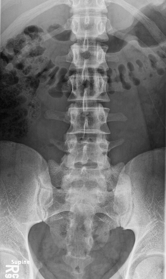 Bertolotti's Syndrome Society | Learn about Bertolotti's Syndrome