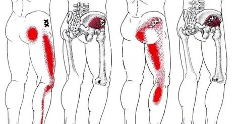 Think You Have Sciatica? 5 Common Conditions That Mimic Sciatic Nerve ...