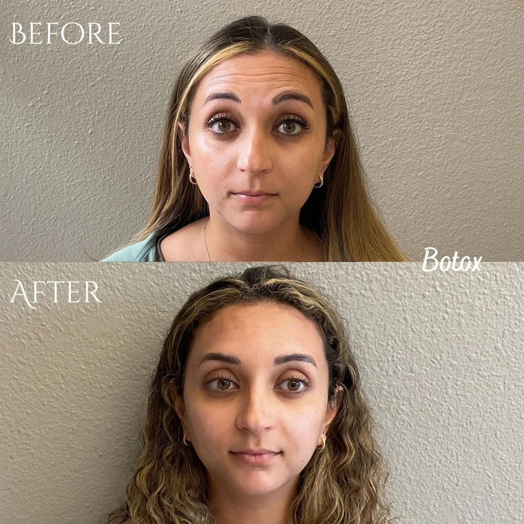 Facial Balancing Before & After: San Juan Capistrano | SM Drip
