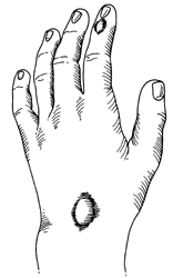 Ganglion Cysts — West LA Hand Center