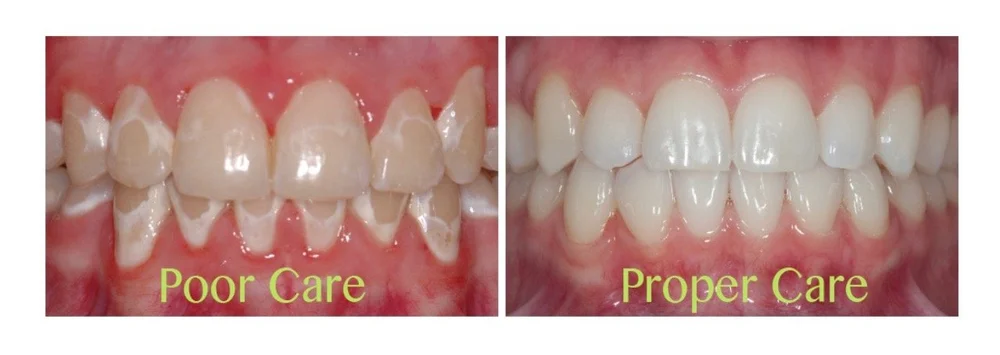 Orthodontic Scars and How to Avoid Them — Go Forth and Smile Orthodontics