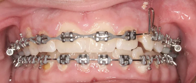 Orthodontic Scars and How to Avoid Them — Go Forth and Smile Orthodontics