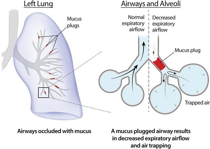 Do I Have Mucus Plugs? — COPD Online - Donald A. Mahler, M.D.