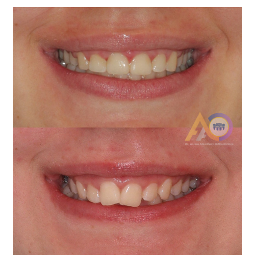 Maxillary incisor intrusion with miniscrews — Dr. Aslam Alkadhimi