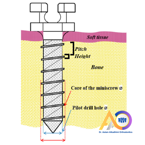 A simple guide to orthodontic miniscrews. Part 1: history and success ...