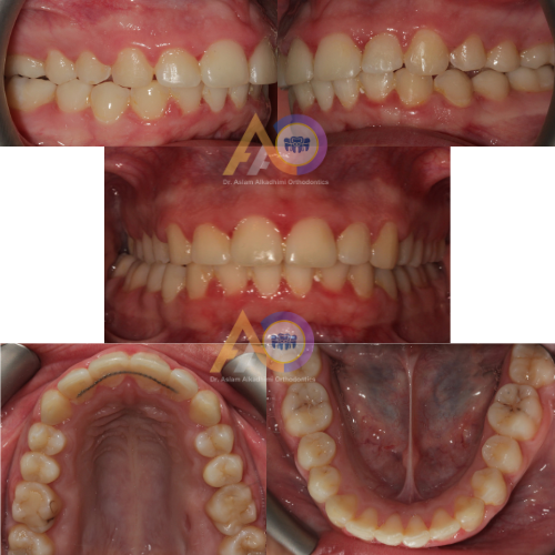 Maxillary incisor intrusion with miniscrews — Dr. Aslam Alkadhimi