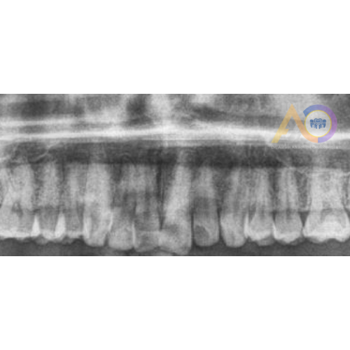 Maxillary incisor intrusion with miniscrews — Dr. Aslam Alkadhimi