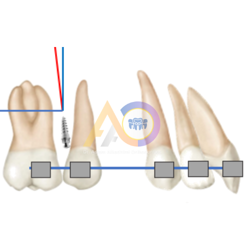 A simple guide to orthodontic miniscrews. Part 3: possible ...