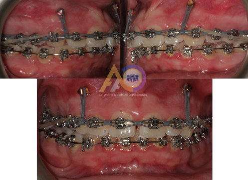 Maxillary incisor intrusion with miniscrews — Dr. Aslam Alkadhimi