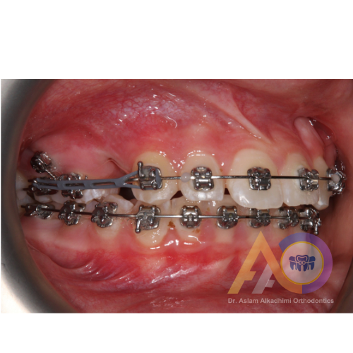 A simple guide to orthodontic miniscrews. Part 3: possible ...