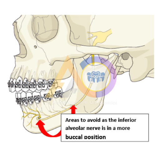 A simple guide to orthodontic miniscrews. Part 3: possible ...