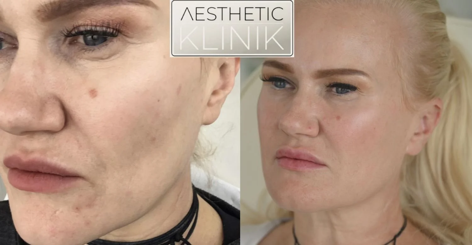 Skin Booster Injections Brighton | Aesthetic Klinik