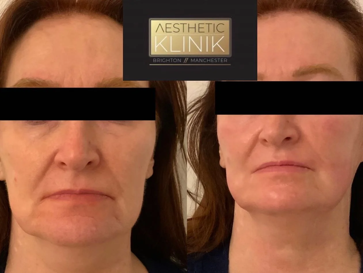 HIFU Non Surgical Facelift Brighton | Aesthetic Klinik