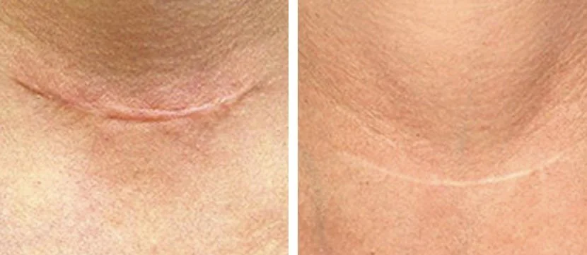 Micro-Needling with Radio-Frequency | Aesthetic Klinik