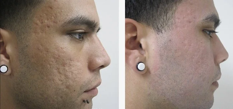 Micro-Needling with Radio-Frequency | Aesthetic Klinik