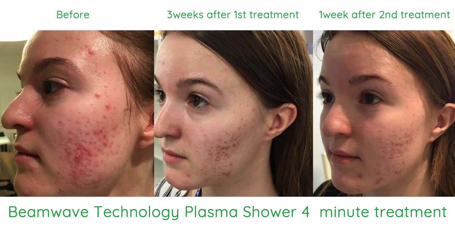 Plasonic Thermal Plasma Brighton | Aesthetic Klinik