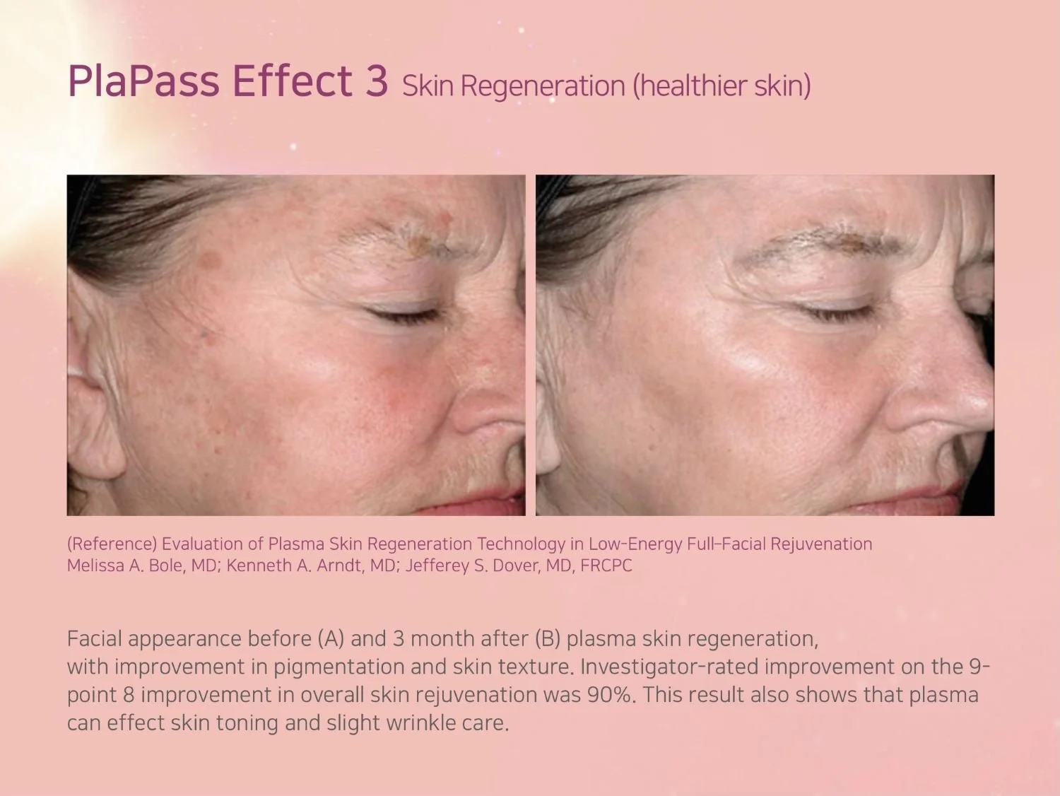 Plasonic Thermal Plasma Brighton | Aesthetic Klinik