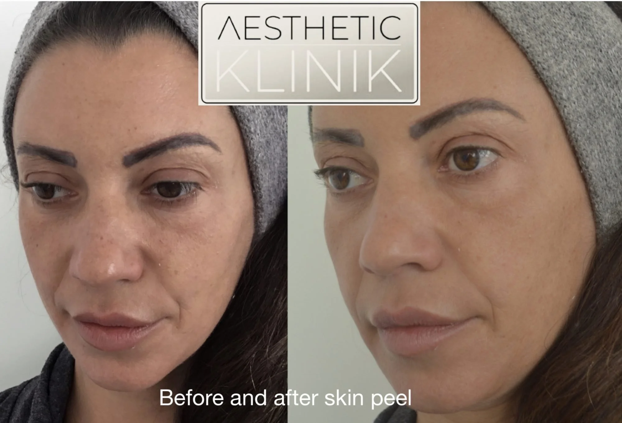 Skin Peels Chemical Peels in Brighton | Aesthetic Klinik