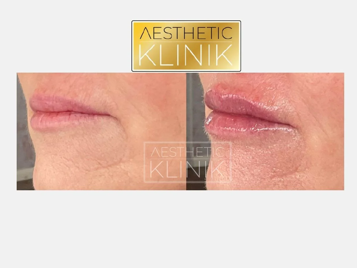 Dermal Fillers Treatment Brighton | Aesthetic Klinik