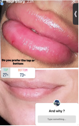 Do All Under 25s Want Overfilled Lips? | Aesthetic Klinik