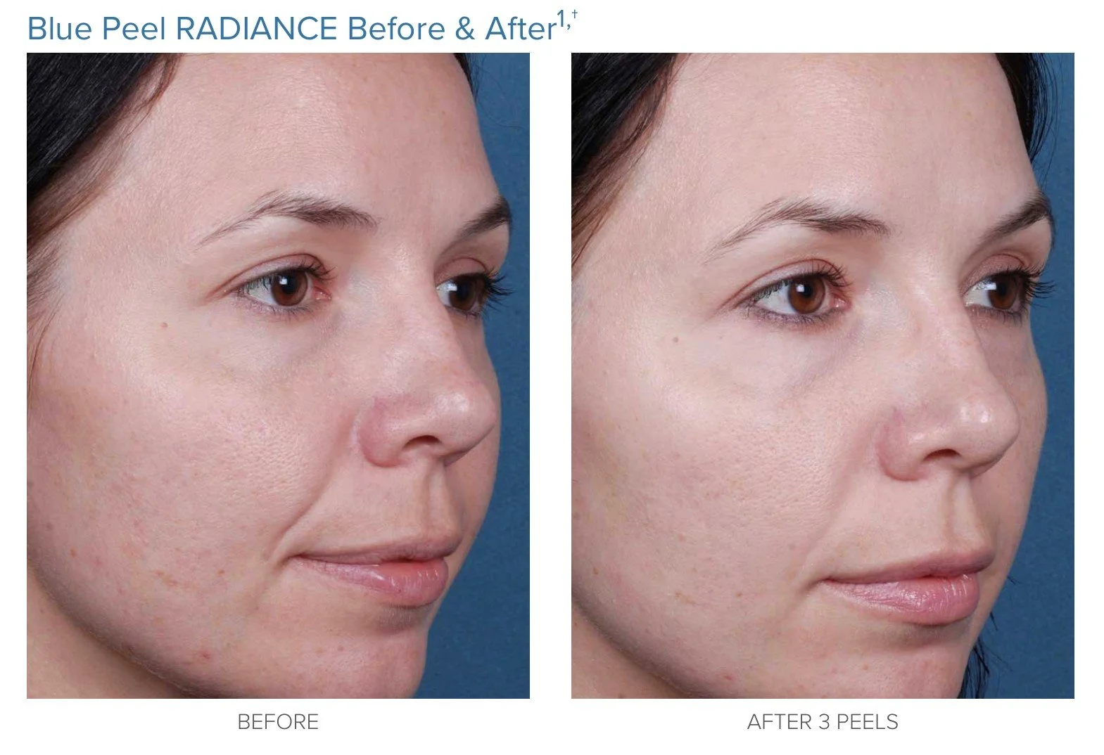 Skin Peels Chemical Peels in Brighton | Aesthetic Klinik