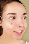 Acne Injections: Rapid Relief for Cystic and Nodular Acne — Allie ...