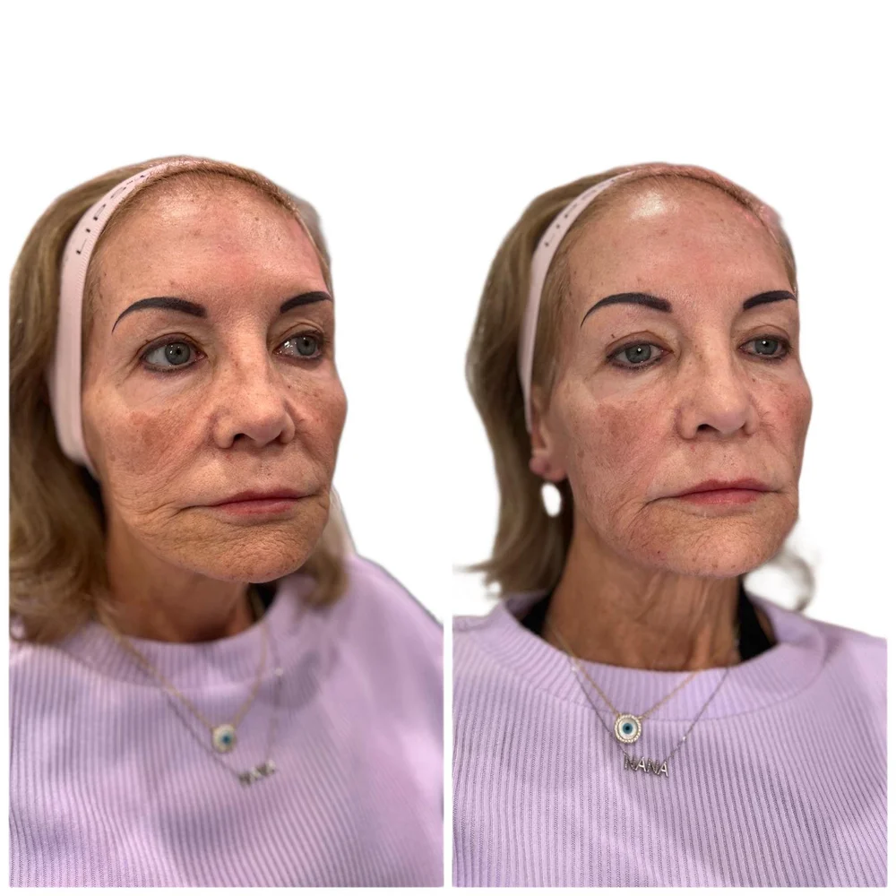 BOTOX — Allie Aesthetics