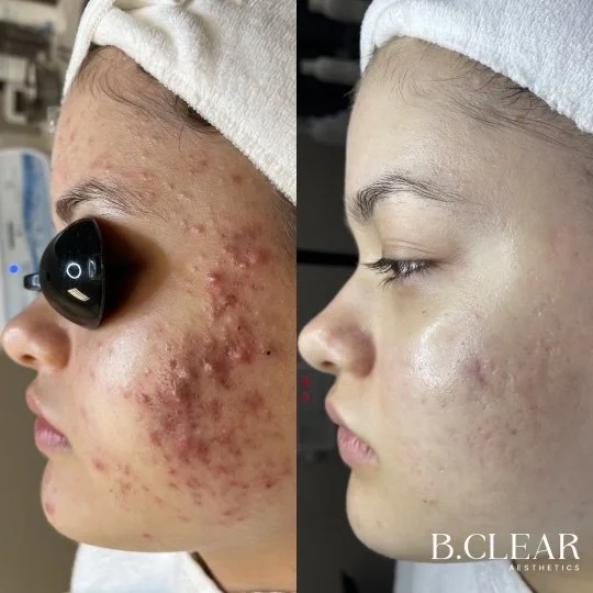 Chemical Peels & Facials in Beaverton — B. Clear