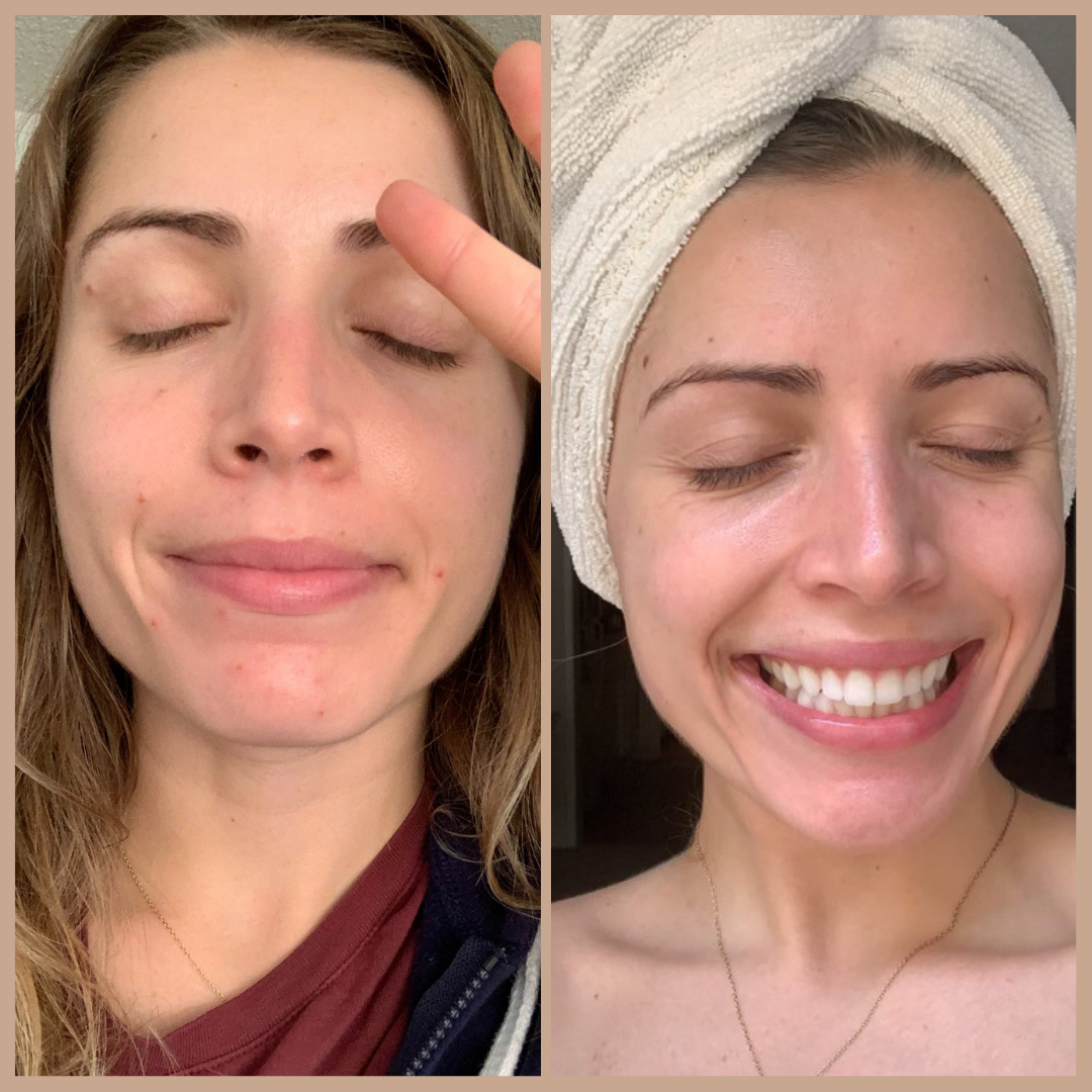 The acne (management) formula — TessaSkin