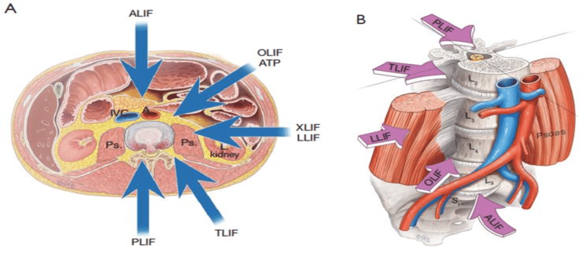 Understanding Lumbar Fusion: Five Approaches for Interbody (Spacer ...