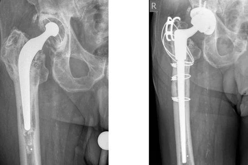 Types of Hip Replacement — Mr Murali Krishnan | Specialist Hip and Knee ...