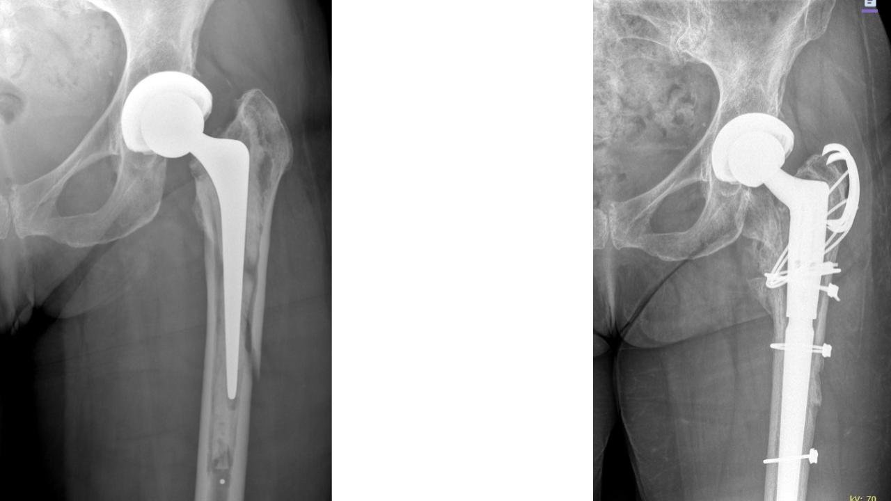 Types of Hip Replacement — Mr Murali Krishnan | Specialist Hip and Knee ...