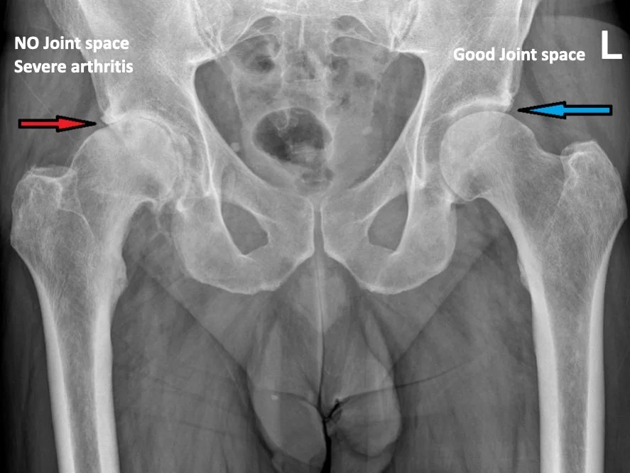 What is Arthritis — Mr Murali Krishnan | Specialist Hip and Knee Surgeon
