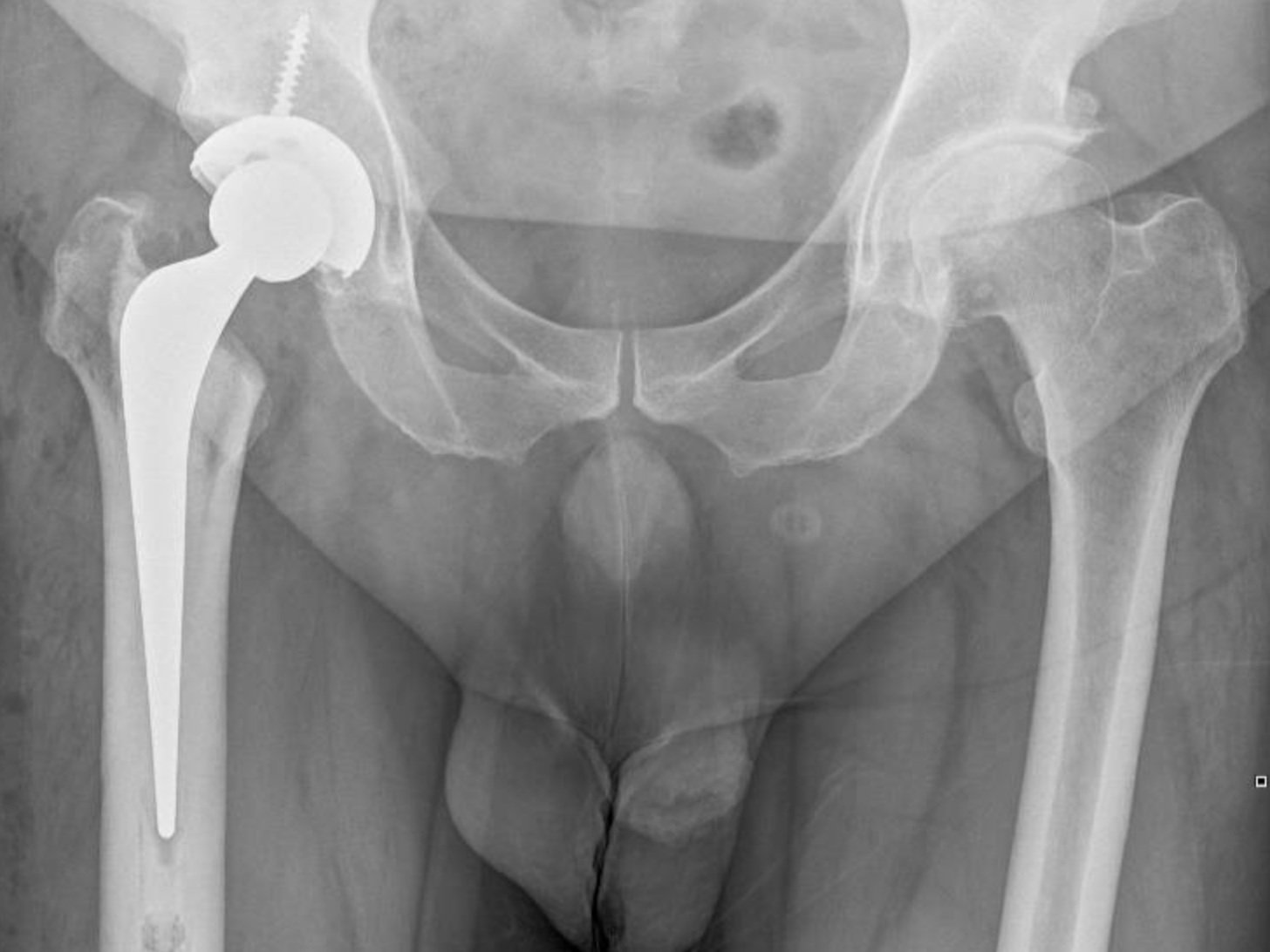 Types of Hip Replacement — Mr Murali Krishnan | Specialist Hip and Knee ...