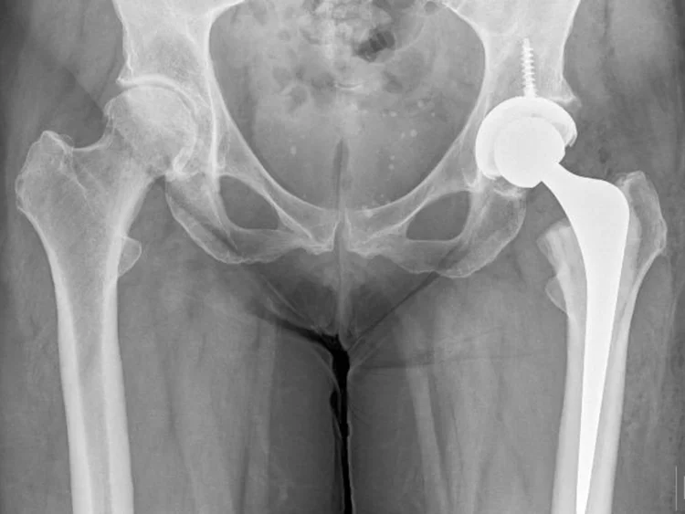 Types of Hip Replacement — Mr Murali Krishnan | Specialist Hip and Knee ...