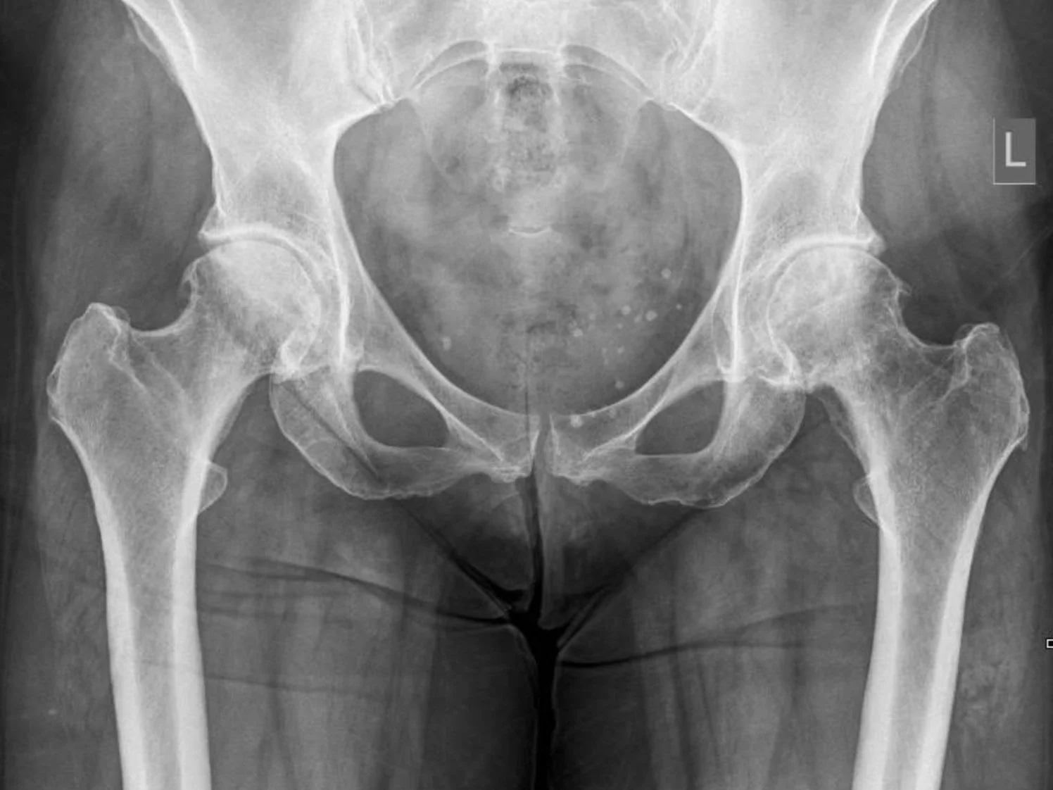 Types of Hip Replacement — Mr Murali Krishnan | Specialist Hip and Knee ...