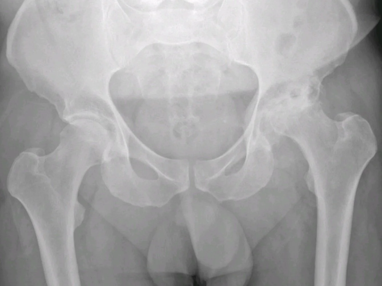 Types of Hip Replacement — Mr Murali Krishnan | Specialist Hip and Knee ...