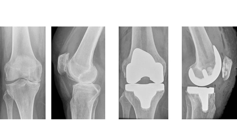 Types of Knee Replacement — Mr Murali Krishnan | Specialist Hip and ...