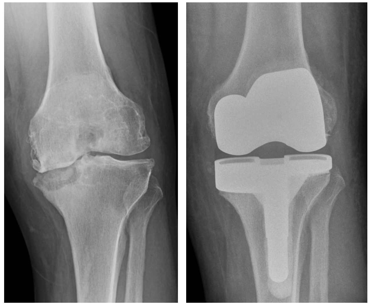 Types of Knee Replacement — Mr Murali Krishnan | Specialist Hip and ...