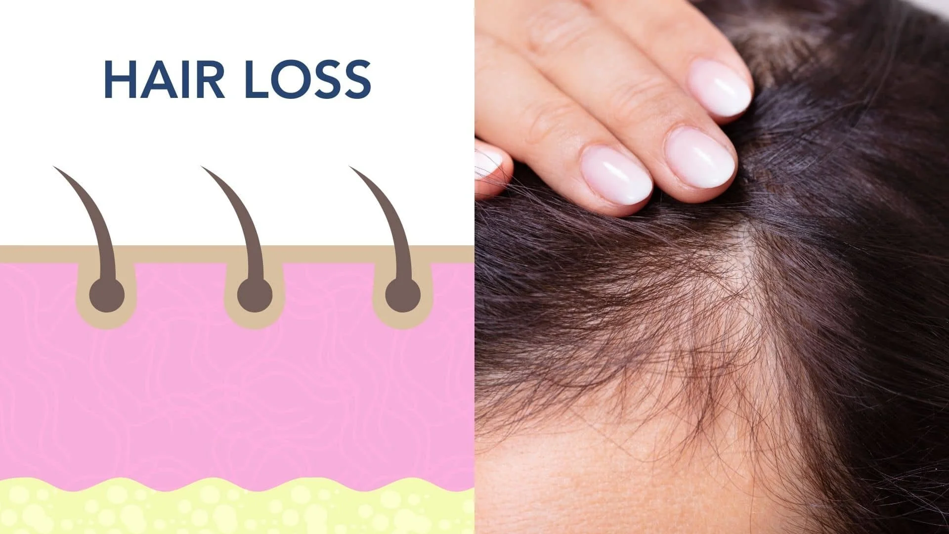 Doctor’s Note: Your Easy Guide to Female Pattern Hair Loss