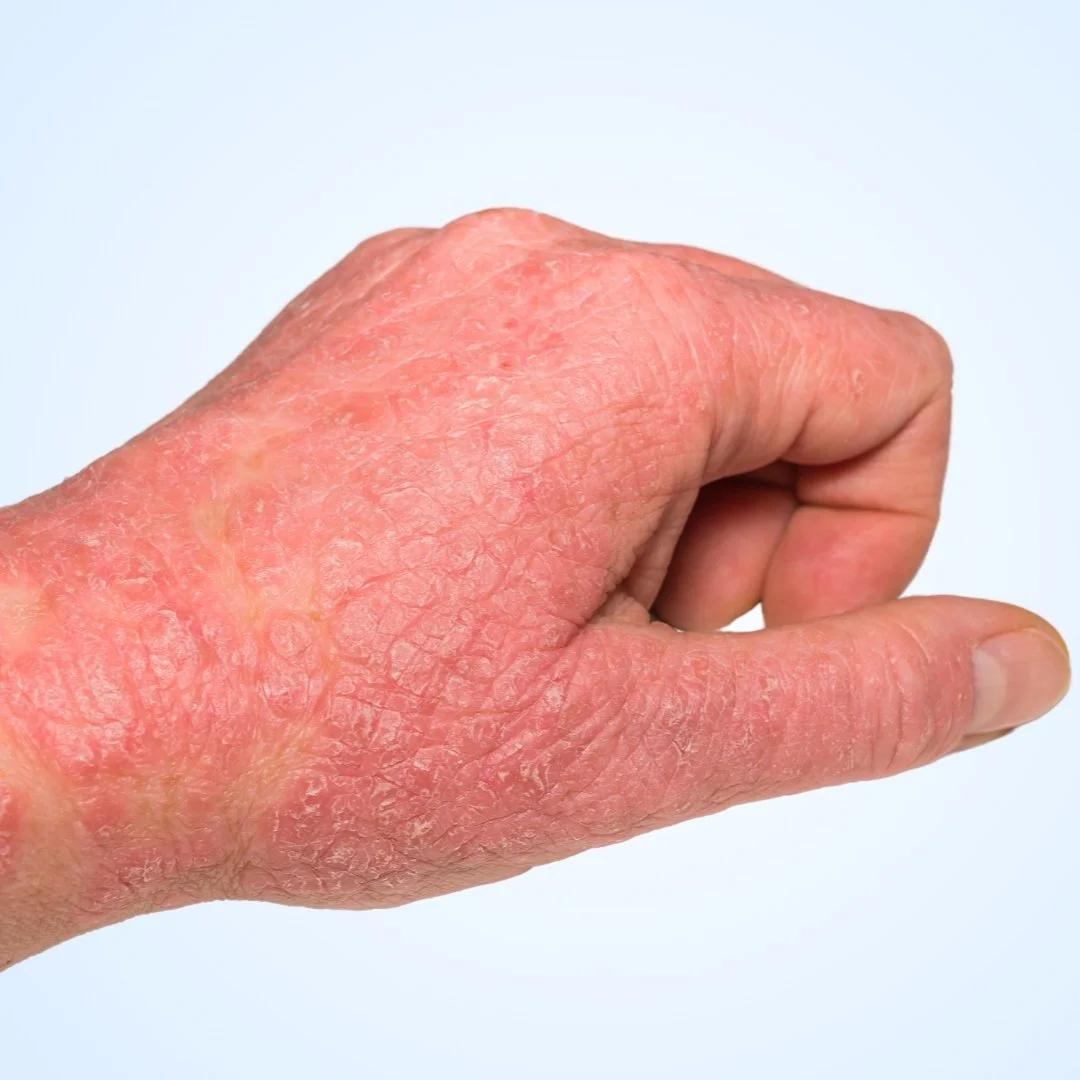 Doctor’s Note: Your Essential Guide to Hand Dermatitis