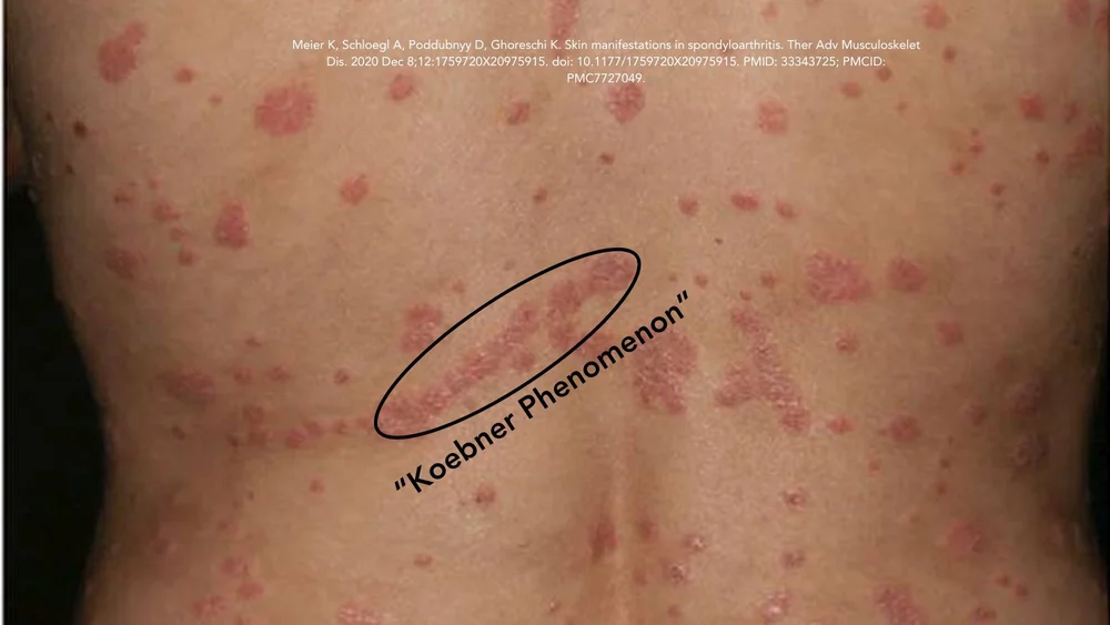 5 Types of Psoriasis: Symptoms, Locations, and Treatments