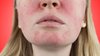 Doctor’s Note: Your Essential Guide to Rhofade for Rosacea