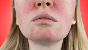 Doctor’s Note: Your Essential Guide to Rhofade for Rosacea