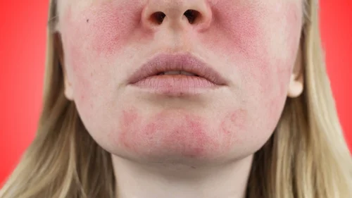 Doctor’s Note: Your Essential Guide to Rhofade for Rosacea
