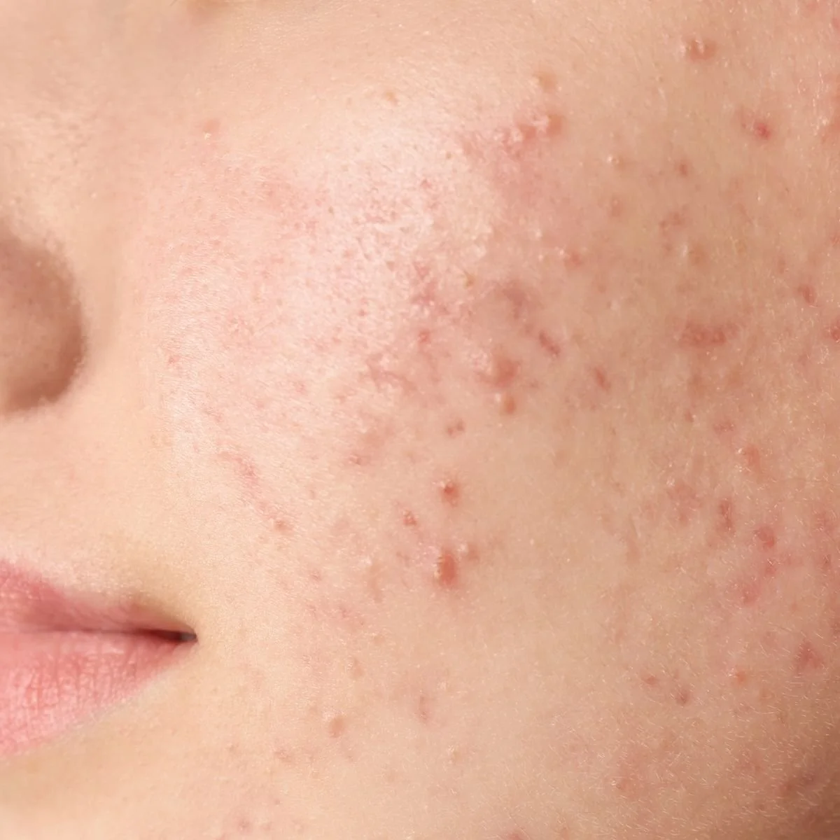 Doctor’s Note: Your Easy + Essential Guide to Accutane