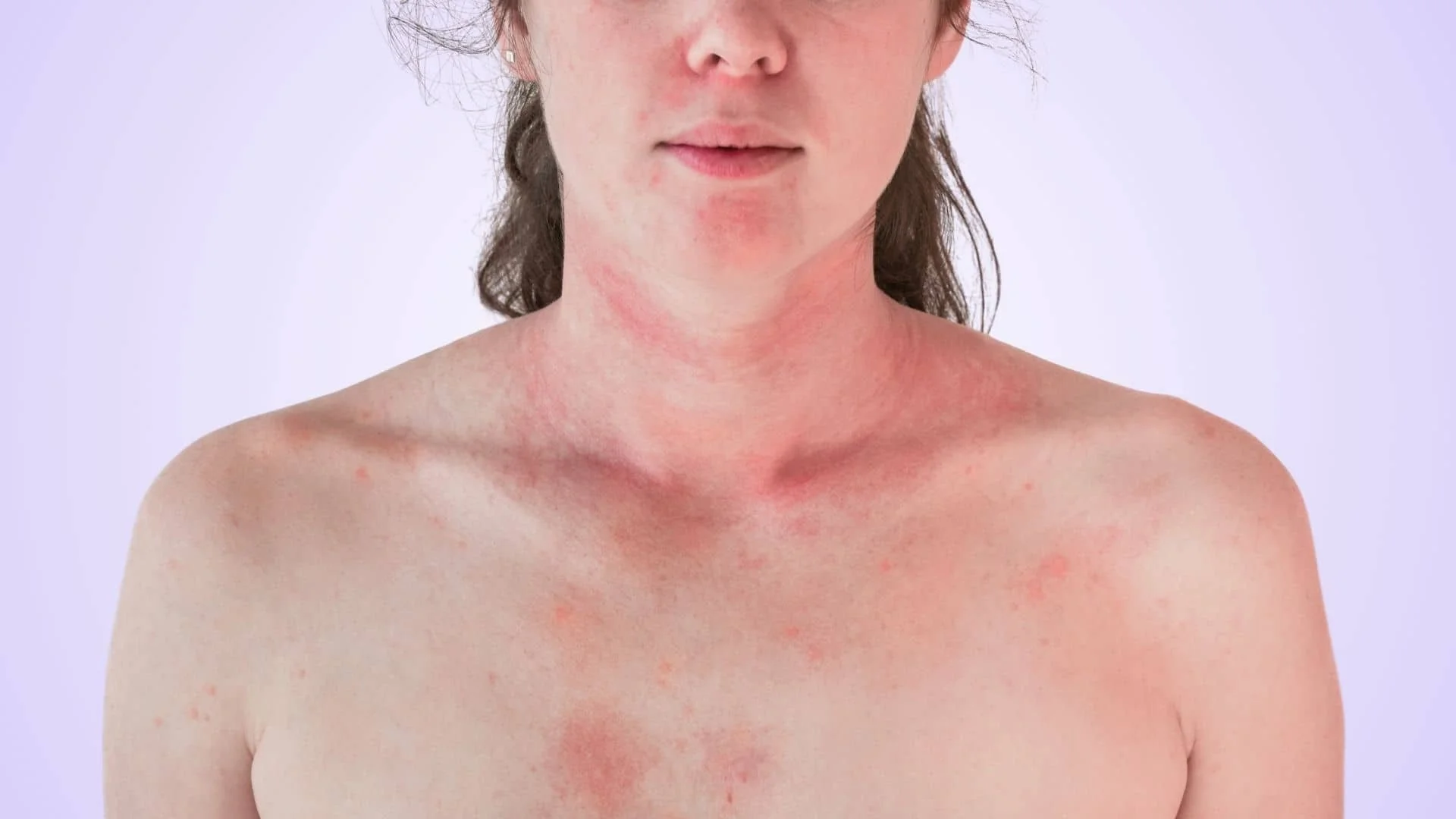 Doctor’s Note: Your Essential Guide to Eczema Treatments