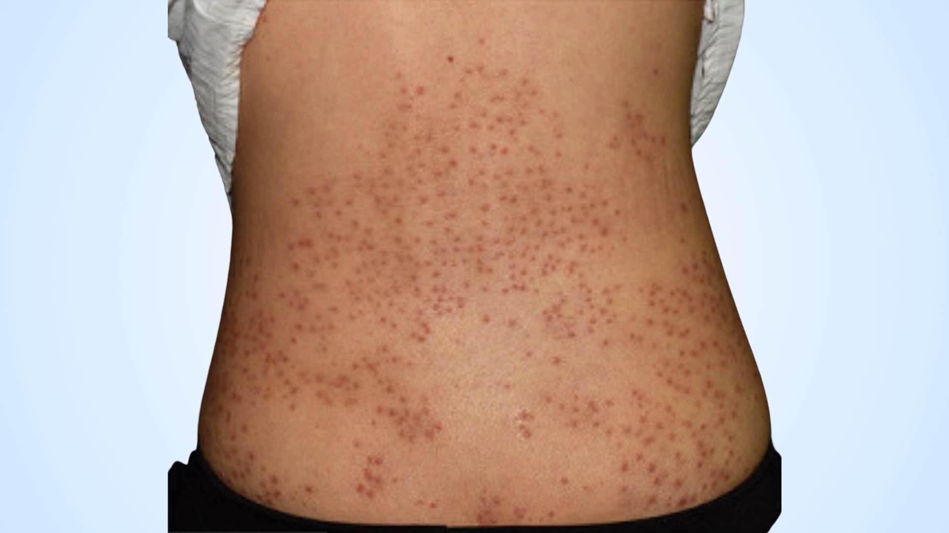 5 Types of Psoriasis: Symptoms, Locations, and Treatments