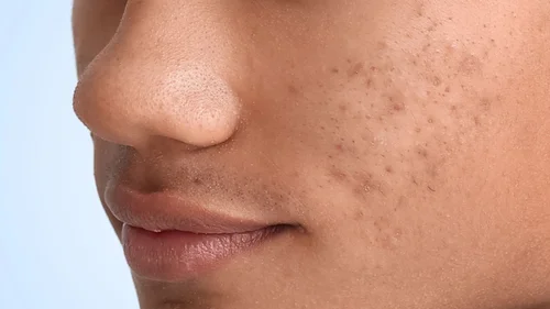 Doctor’s Note: Your Essential Guide to Hydroquinone