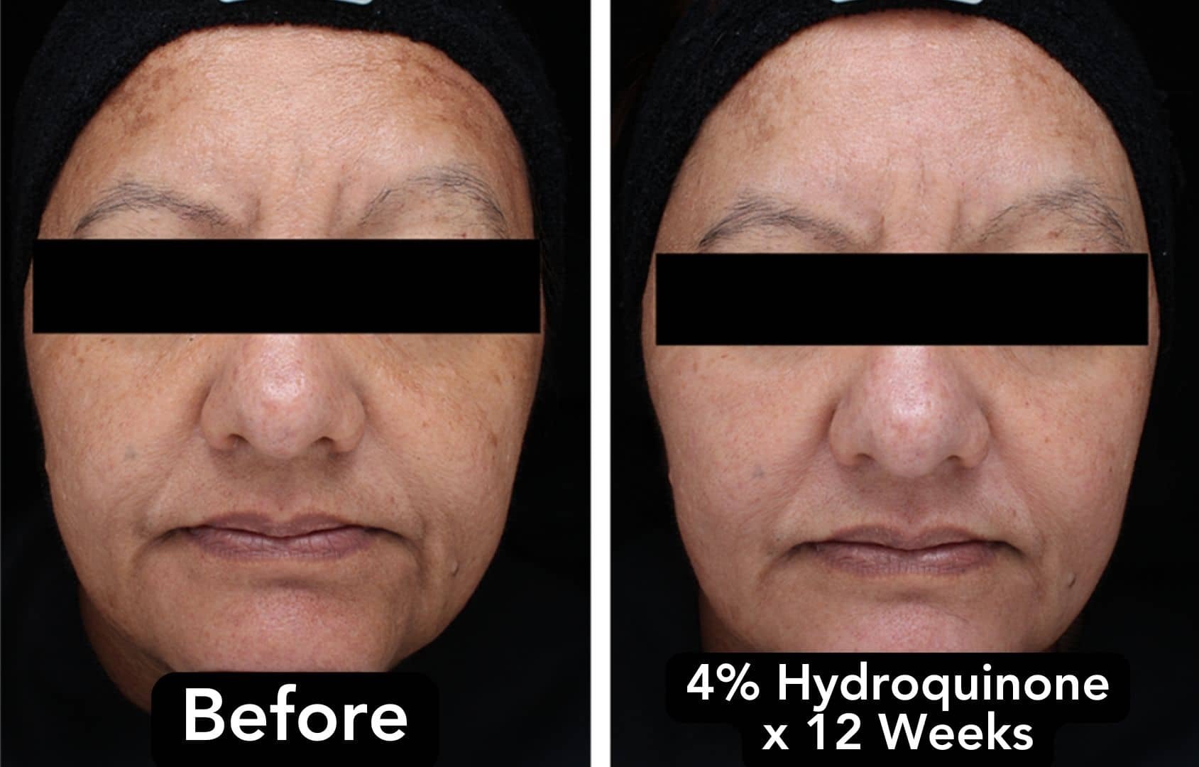 Doctor’s Note: Your Essential Guide to Hydroquinone